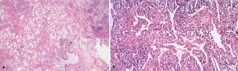 Interstitielle Lungenerkrankungen | SpringerLink