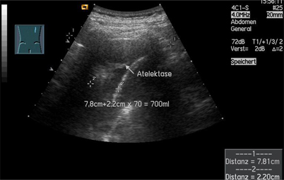 Pleuraerguss und pleuraständige Tumoren | SpringerLink