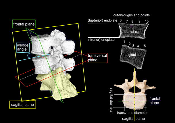 Geometry of the Intervertebral Volume and Vertebral Endplates of the ...