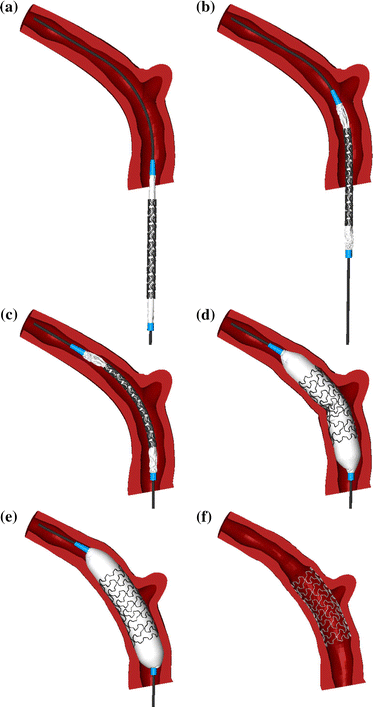 A Novel Simulation Strategy for Stent Insertion and Deployment in ...