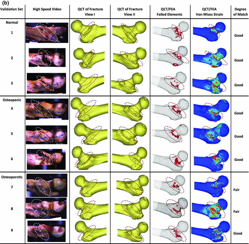 Robust QCT/FEA Models of Proximal Femur Stiffness and Fracture Load ...