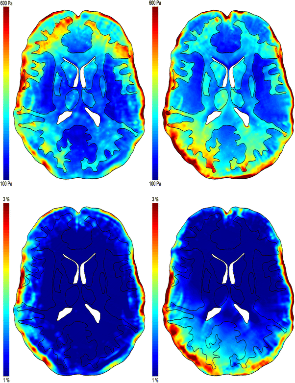 Development of a Finite Element Model for Blast Brain Injury and the ...