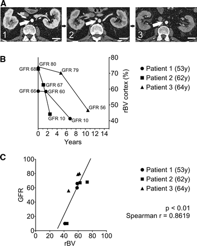 Contrast-enhanced CT imaging in patients with chronic kidney disease ...