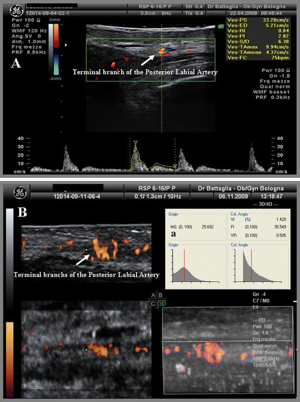 2D and 3D Ultrasound Examination of Labia Minora | SpringerLink