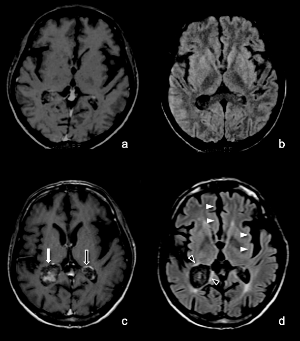 Enlarging brain xanthomas in a patient with cerebrotendinous ...