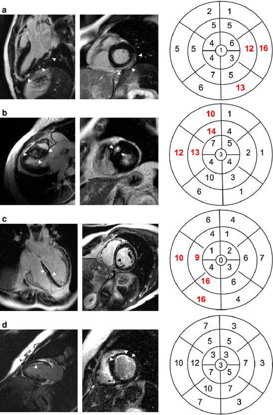 Delayed enhancement cardiac magnetic resonance imaging reveals typical ...