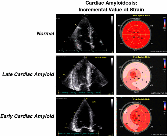 Strain imaging in echocardiography: methods and clinical applications ...