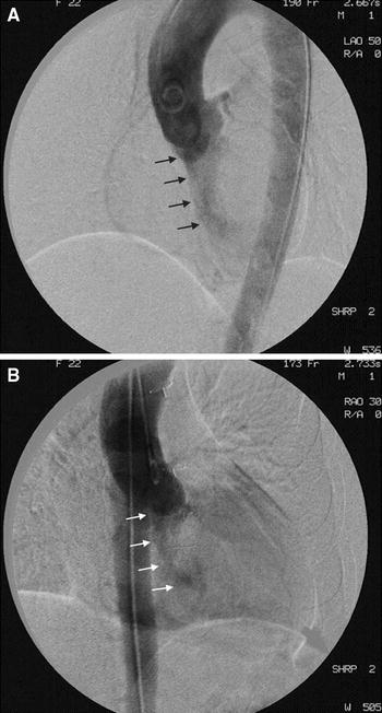 A case of iatrogenic aortic valve leaflet perforation after closure of ...