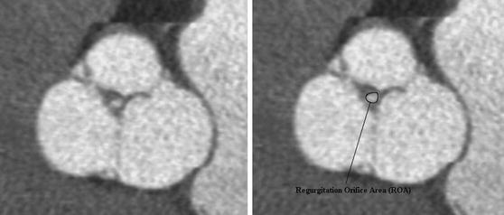 Central aortic valve coaptation area during diastole as seen by 64 ...
