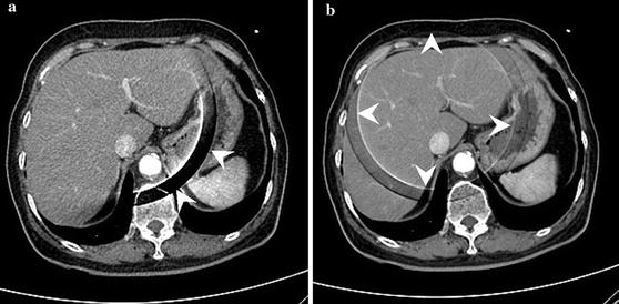 Partial ring artifact on cardiac CT: image presentation and clinical ...