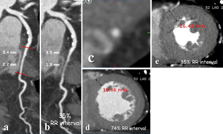 Systolic luminal narrowing and morphologic characteristics of ...
