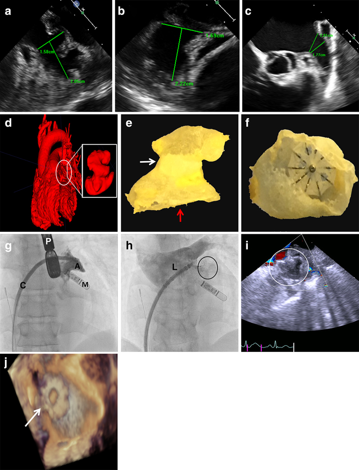 Patient specific 3D print of left atrial appendage for closure device ...