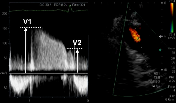 A new method to estimate pulmonary vascular resistance using diastolic ...