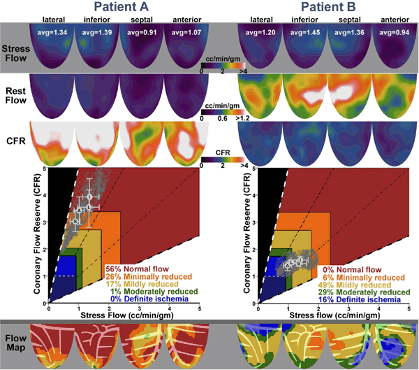 Coronary flow capacity: concept, promises, and challenges | SpringerLink