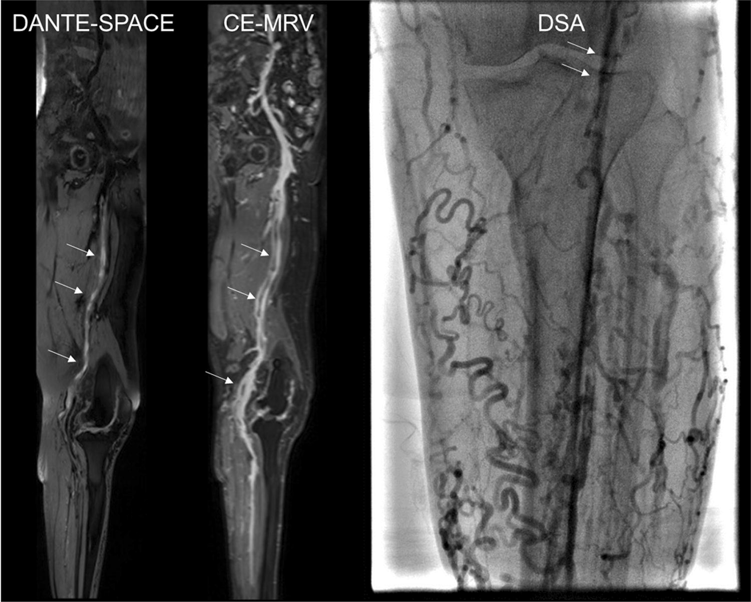DANTE-SPACE: a new technical tool for DVT on 1.5T MRI | SpringerLink