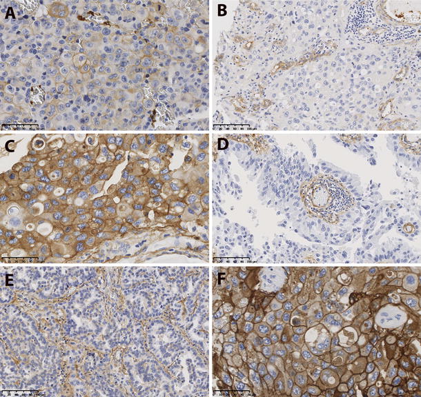 αvβ3, αvβ5 and αvβ6 integrins in brain metastases of lung cancer ...