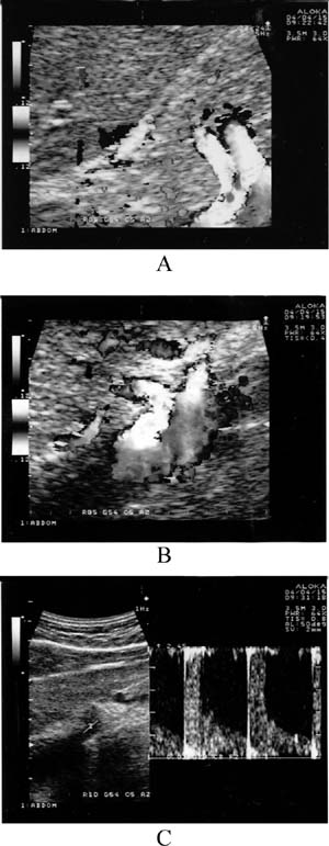 Dunbar’s Syndrome and Superior Mesenteric Artery’s Syndrome: A Rare ...