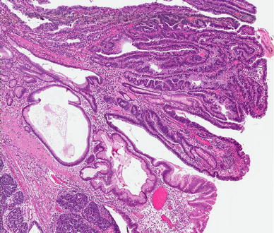 Gastric Hyperplastic Polyps: A Review | SpringerLink