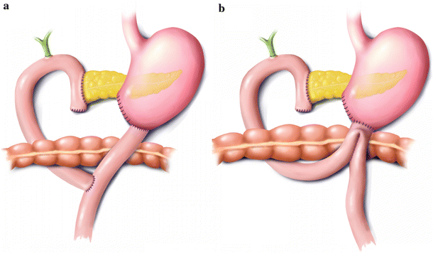 Does Modified Braun Enteroenterostomy Improve Alkaline Reflux Gastritis ...