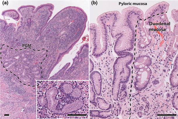 Chronic Pouchitis Versus Recurrent Crohn’s Disease: A Diagnostic ...