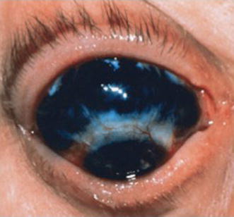 Ocular, Auricular, and Oral Manifestations of Inflammatory Bowel ...