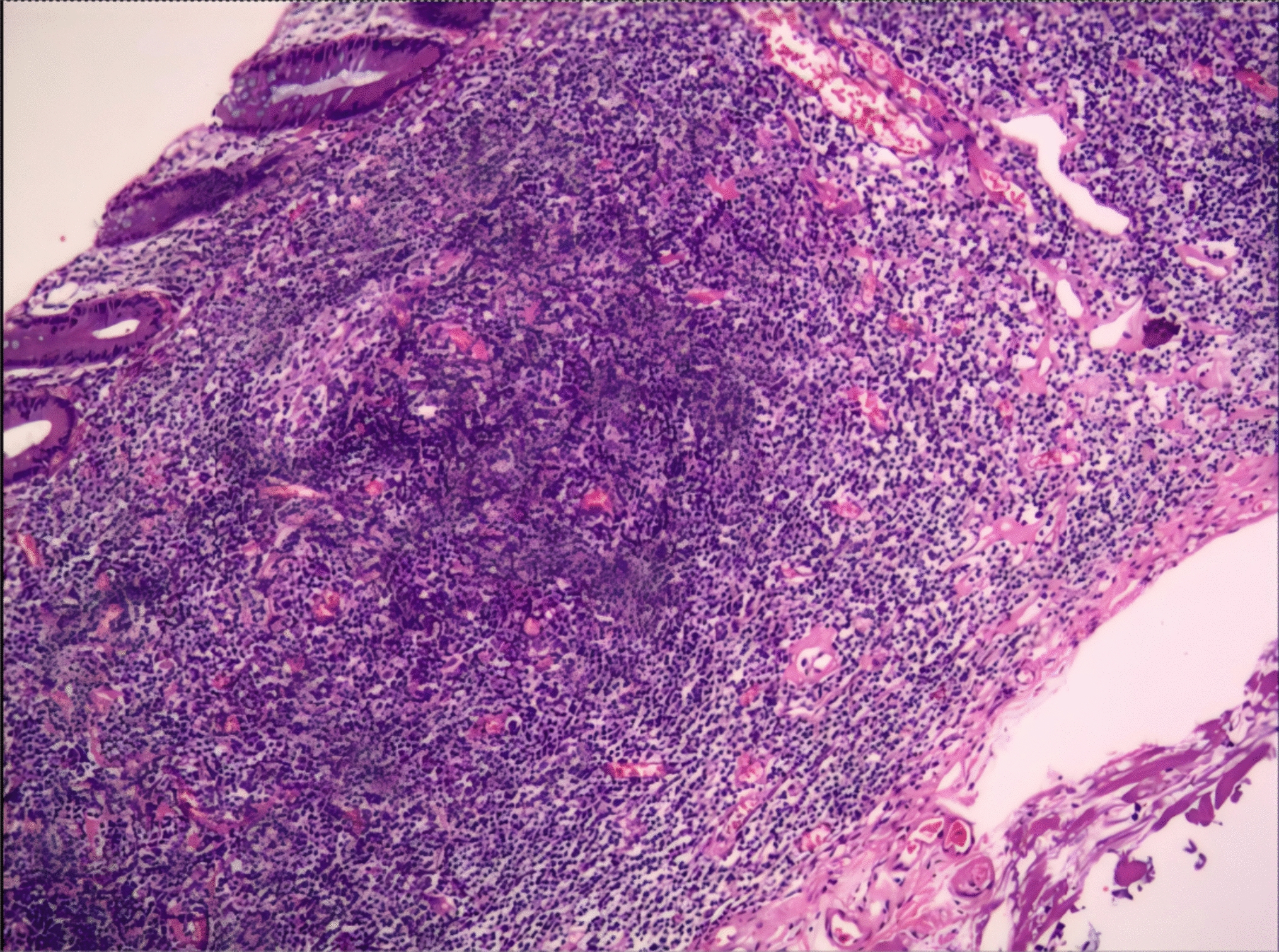 Rare Endoscopic Presentation of Sigmoid Colon MALT Lymphoma ...