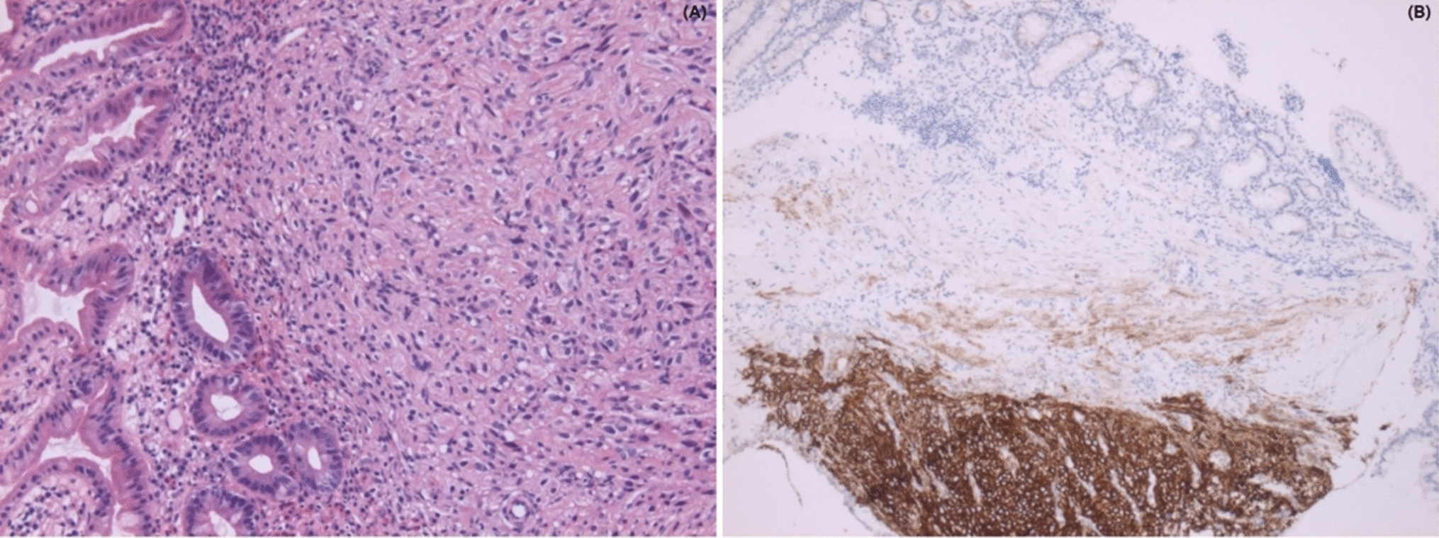 Gastrointestinal Stromal Tumor | Ampullary Gastrointestinal Stromal ...