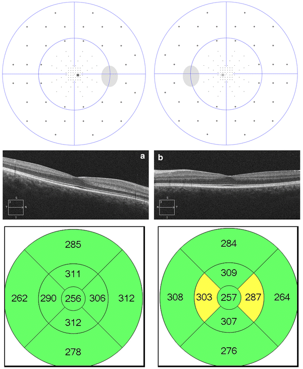 A possible early sign of hydroxychloroquine macular toxicity | SpringerLink