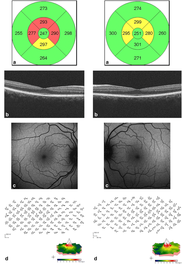 A possible early sign of hydroxychloroquine macular toxicity | SpringerLink