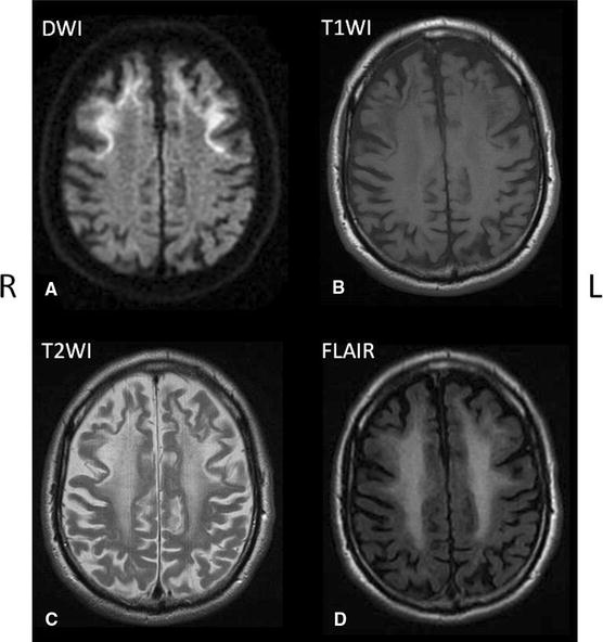 Case of adult-onset neuronal intranuclear hyaline inclusion disease ...