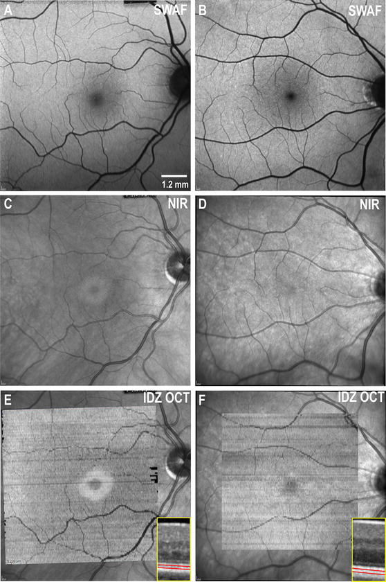 Perifoveal interdigitation zone loss in hydroxychloroquine toxicity ...