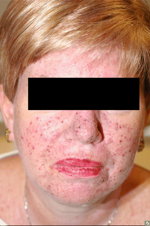 Dermatologic side effects associated with the MEK 1/2 inhibitor ...