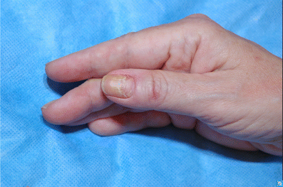 Dermatologic side effects associated with the MEK 1/2 inhibitor ...