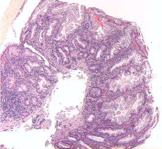 Sessile serrated polyps of the colorectum are rare in patients with ...