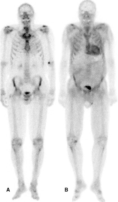 Nuclear imaging for cardiac amyloidosis | SpringerLink