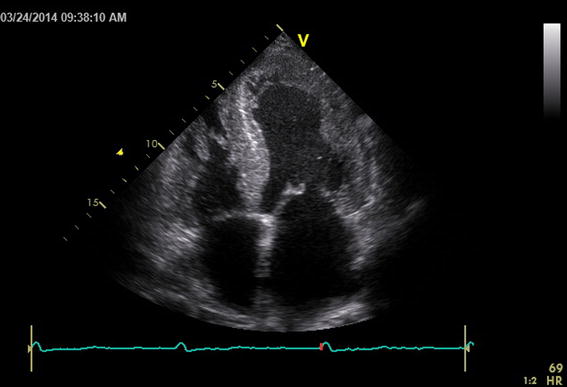 Echocardiography in cardiac amyloidosis | SpringerLink