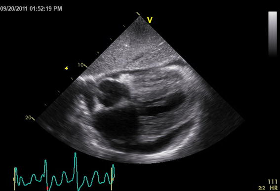 Echocardiography in cardiac amyloidosis | SpringerLink