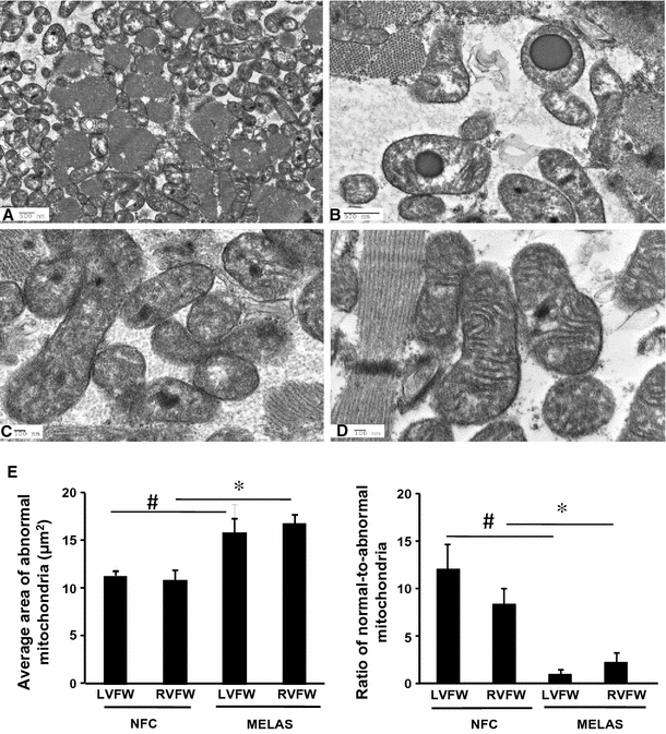 MELAS syndrome and cardiomyopathy: linking mitochondrial function to ...