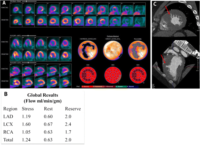 Role of PET to evaluate coronary microvascular dysfunction in non ...