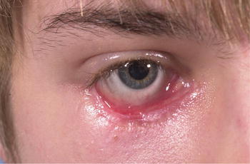 Periorbital necrotising fasciitis: delay in diagnosis results in loss ...