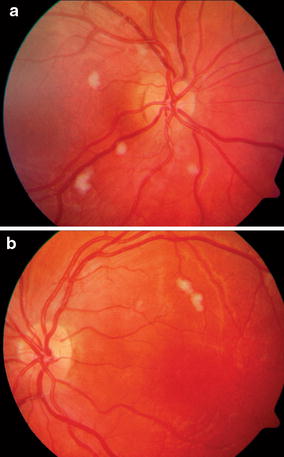 Ocular fat embolism syndrome | SpringerLink