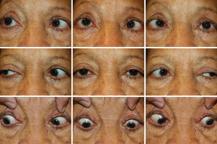 Bilateral oculomotor synkinesis following Miller Fisher syndrome ...