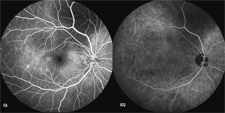 Enhanced depth imaging OCT (EDI-OCT) findings in acute phase of ...