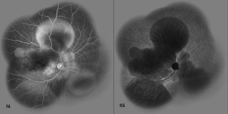 Enhanced depth imaging OCT (EDI-OCT) findings in acute phase of ...
