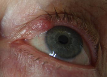 Endocrine mucin-producing sweat gland carcinoma of the eyelid ...