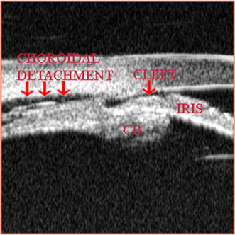 Cyclodialysis: an update | SpringerLink