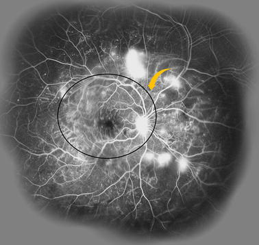 Extended targeted retinal photocoagulation versus conventional pan ...