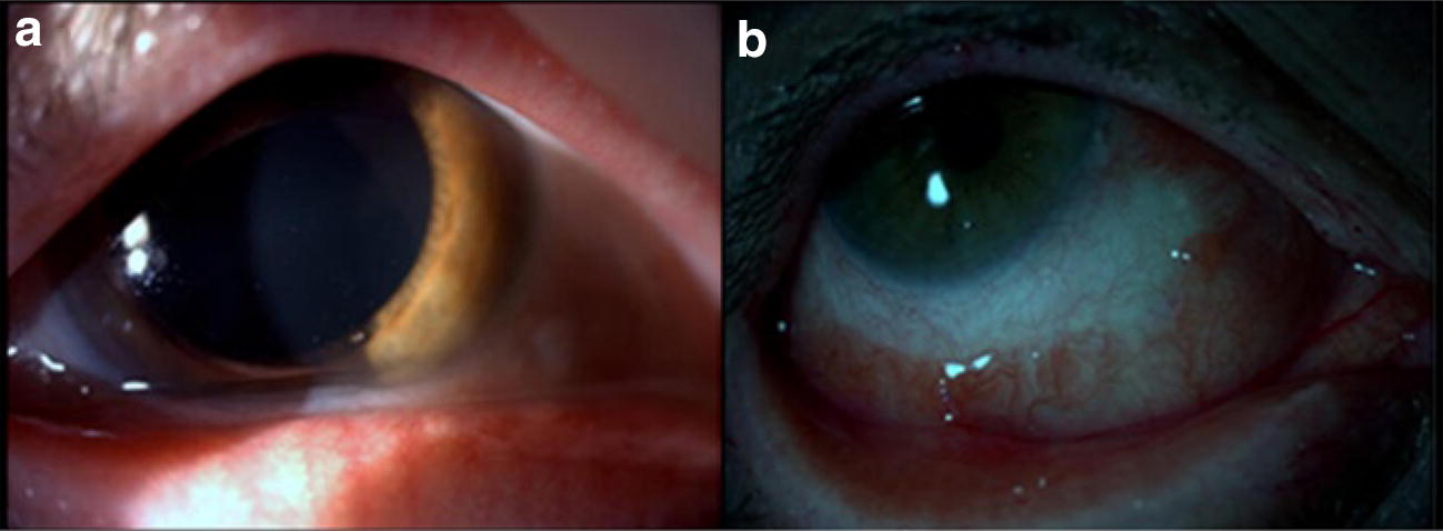 Investigation of conjunctivochalasis histopathology with light and ...