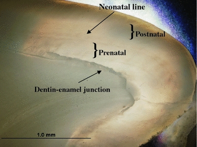 Heavy Metal in Children’s Tooth Enamel: Related to Autism and ...