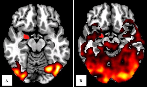 Brief Report: Functional MRI of a Patient with 7q11.23 Duplication ...